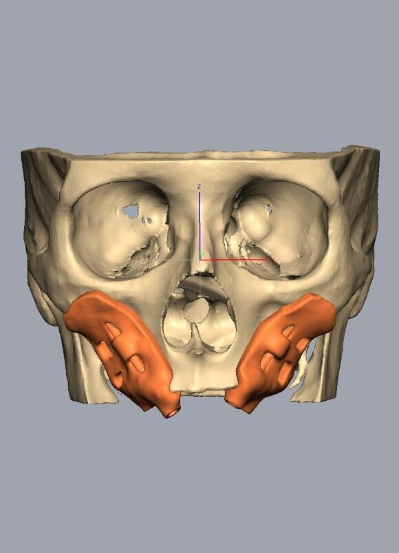 Maxillofacial | LUCID Implants | PSIs for CMF & Ortho
